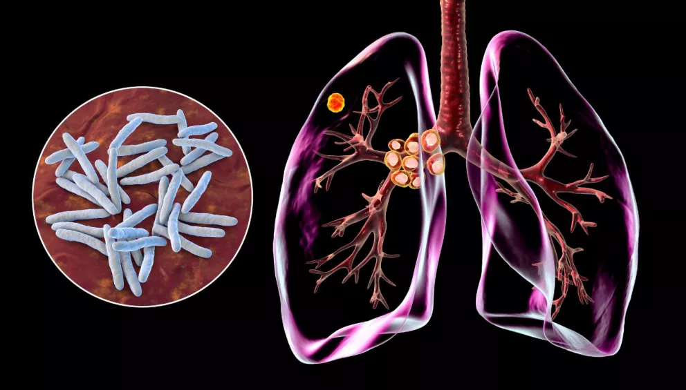 Tuberculosis se propaga en México, estos son los estados más afectados - ATPNoticias
