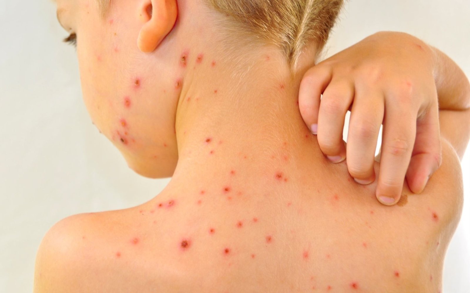 Varicela se propaga en México, estos son los estados con más contagios - ATPNoticias